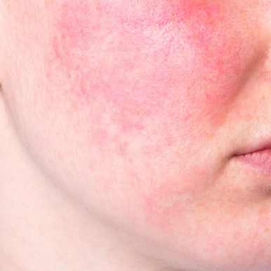 The Healing Benefits of Red Light Therapy For Rosacea – My Store